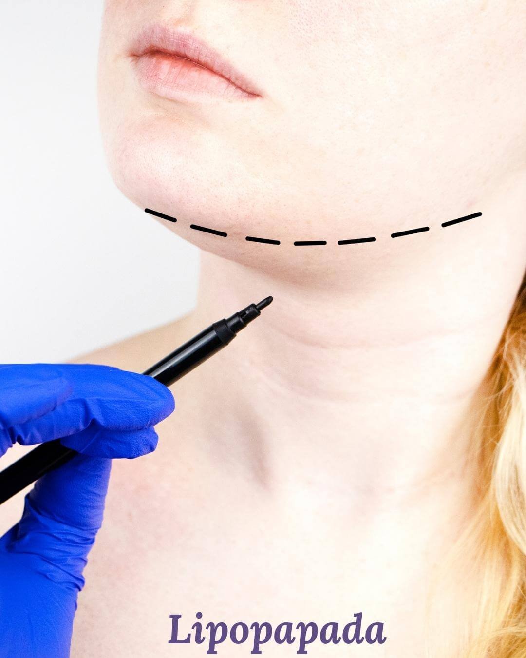 Cirugías faciales y uso postquirúrgico de la mentonera - Viti Control